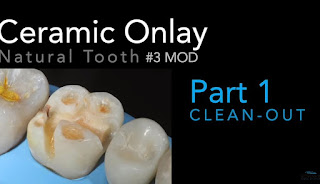 CERAMIC ONLAY: MOD on a Maxillary First Molar. - Dr. Richard G. Stevenson