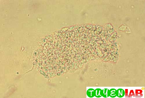 Atlas of Casts in urine | Free Medical Atlas