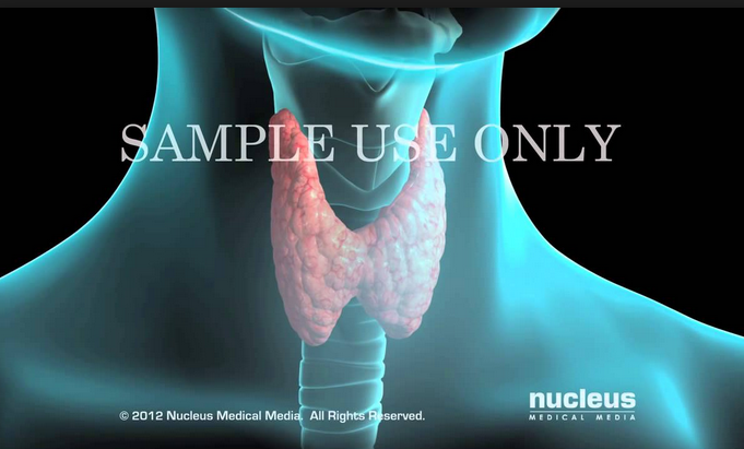 TIROIDEKTOMI - I'm Nurse