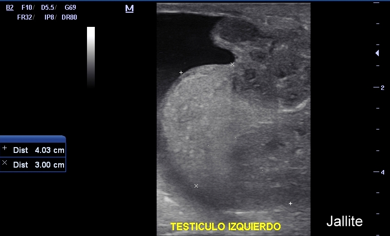 Tuberculosis Testicular