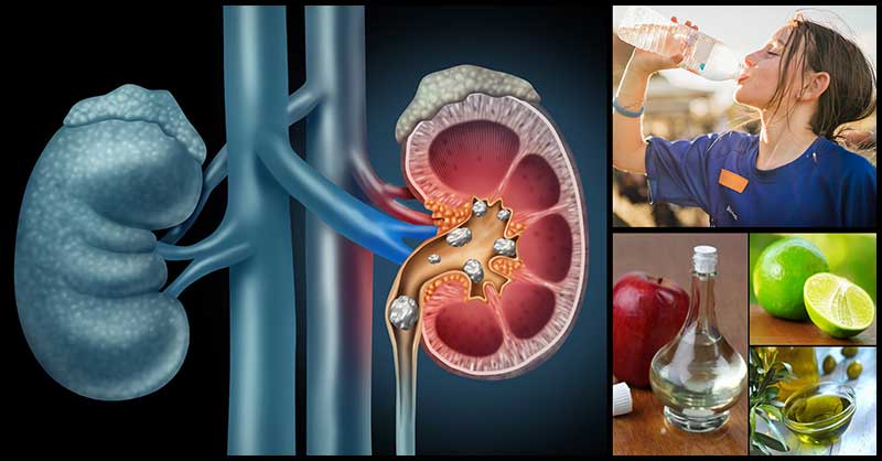 Natural Ways To Help Get Rid Of Kidney Stones | Dr Farrah MD