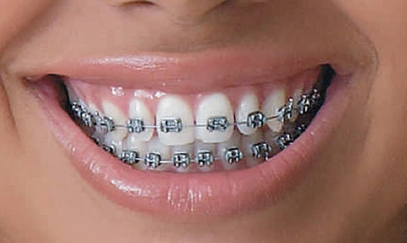 Agregando Cores : Dicas para quem usa/vai usar aparelho! Cor, como ...