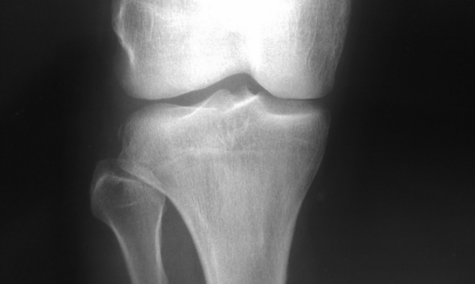 Daily Dose: Segond fracture