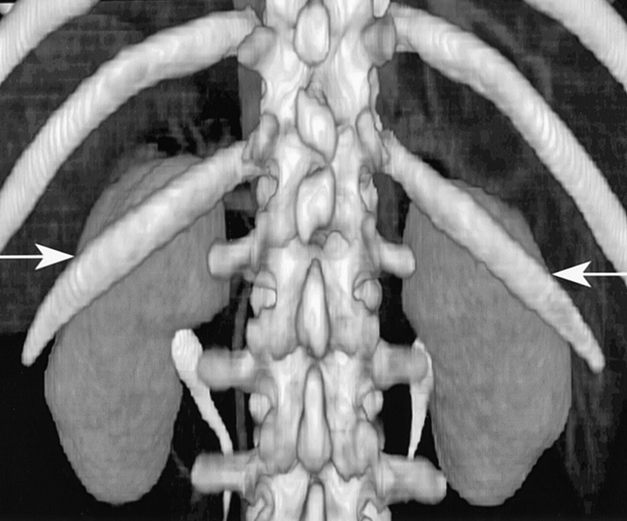 Master of Lithotripsy (ESWL) and ESWT: Treating Upper pole calculus ...