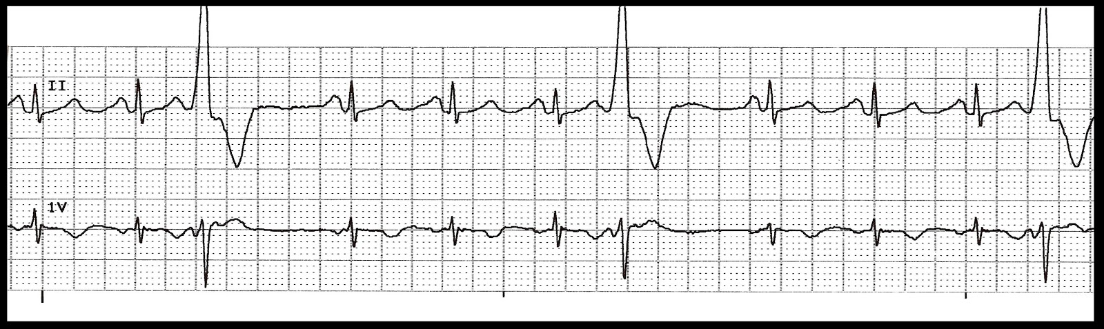 Basic EKG Rhythm Test 34