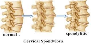 What Is Cervical Spondylosis? | Treatments And Symptoms ...