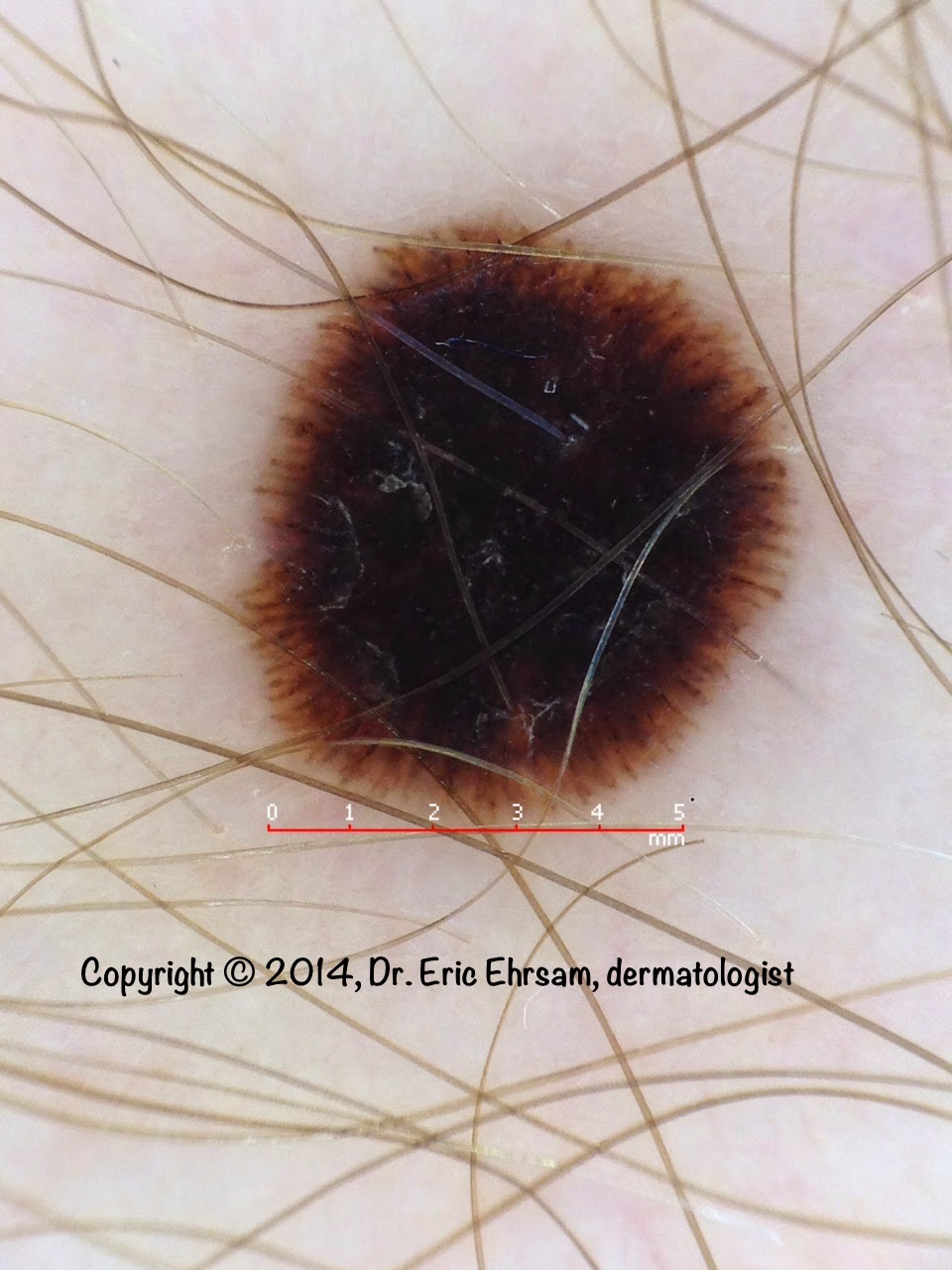 dermoscopy: Starburst pattern