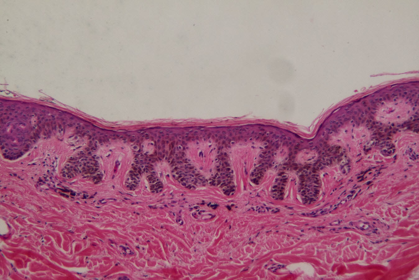 Junctional Nevus Histology