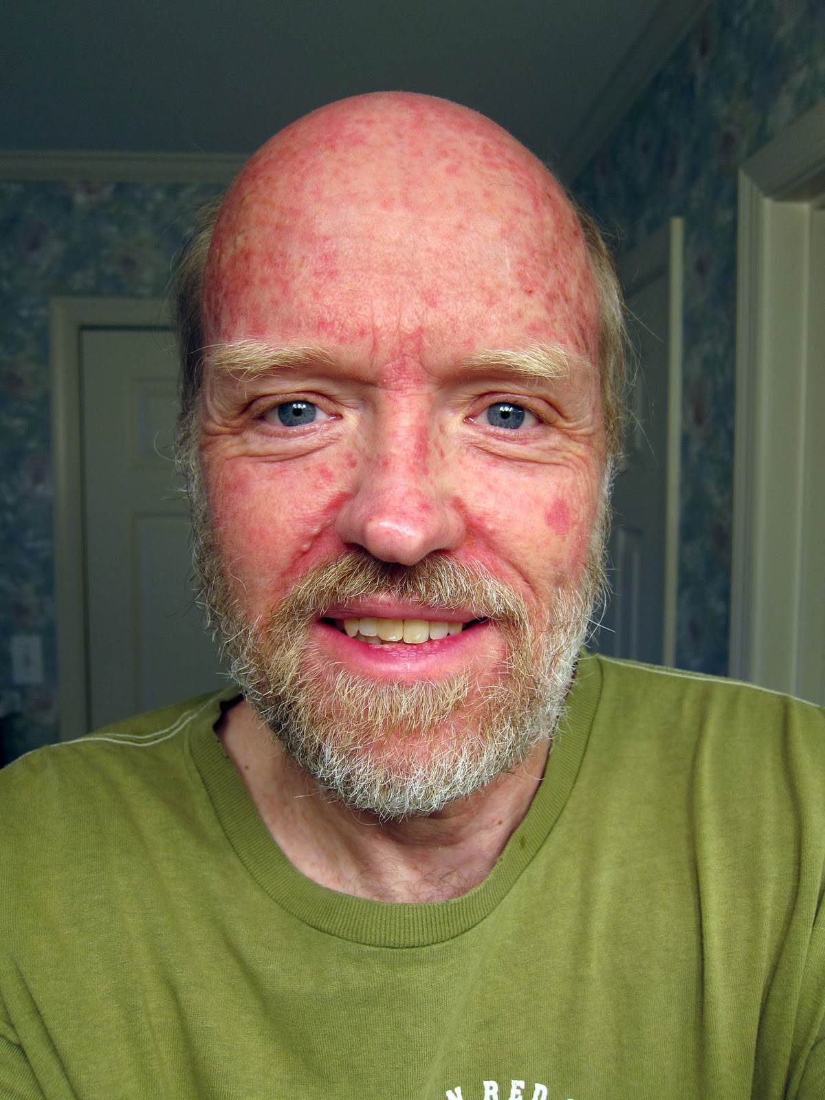 Efudex - Round Two: November 2011