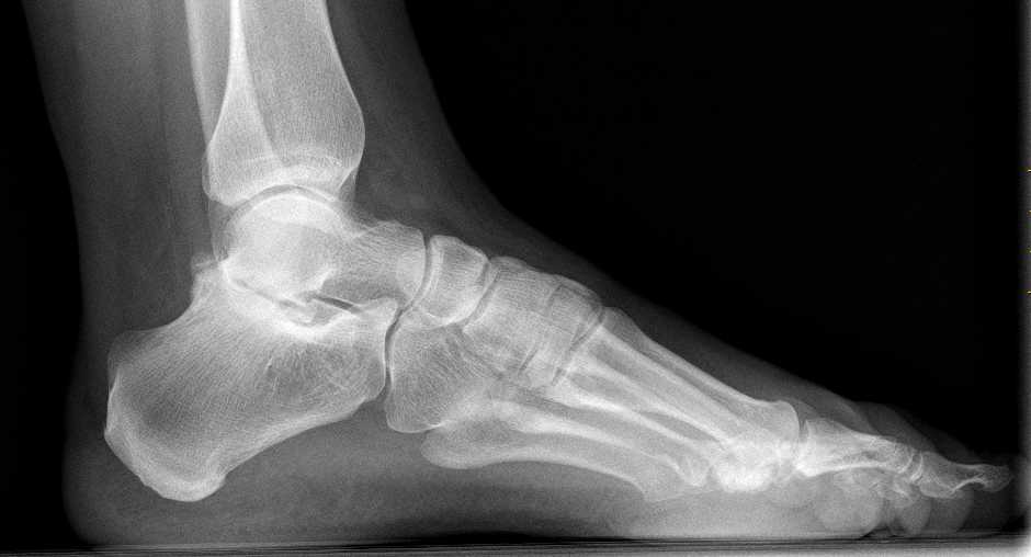 Fanáticos del pie: CASO CLINICO ARTRODESIS SUBASTRAGALINA