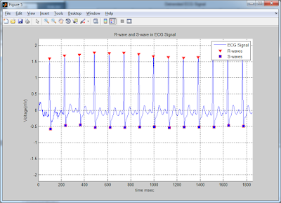 Biomedical Signal and Image Processing projects using Matlab and Labview tools: Matlab code to ...