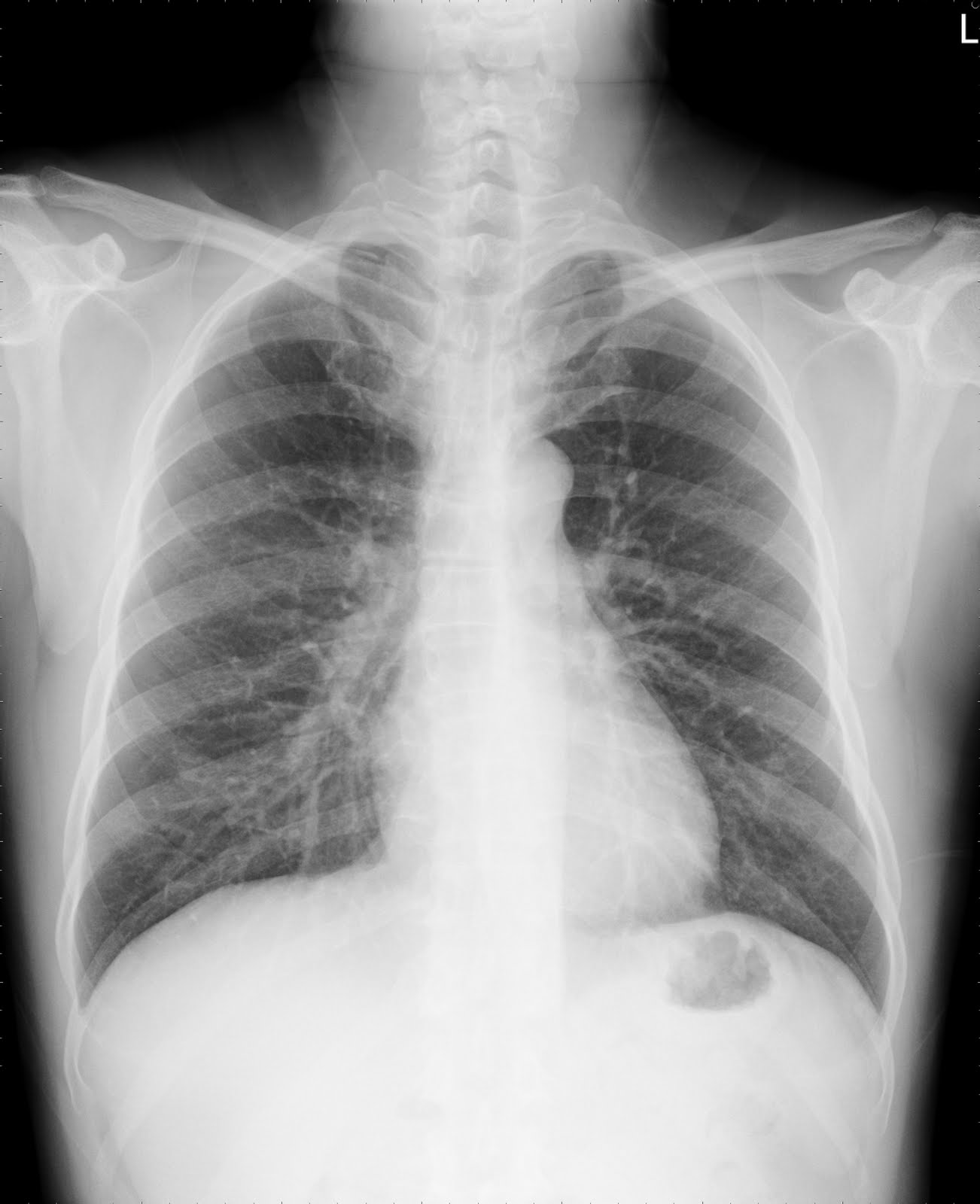 CXR 胸部x光判讀 nipple