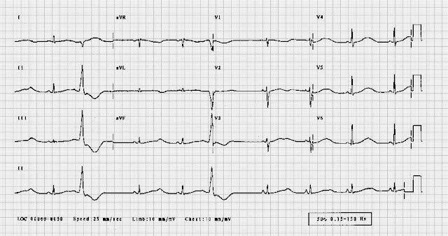 long qt interval | ecg library@fmgsindia
