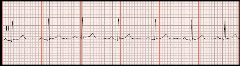 Practice EKG Rhythm Strips 218