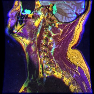 Nevit's blog: Color MRI of the Cervical Spine