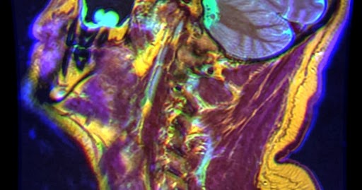 Nevit's blog: Color MRI of the Cervical Spine