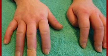 Ayurvedic Treatment for The Sharp Syndrome- Mixed Connective Tissue ...