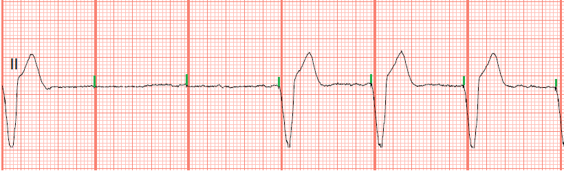 Basic EKG Rhythm Test 45