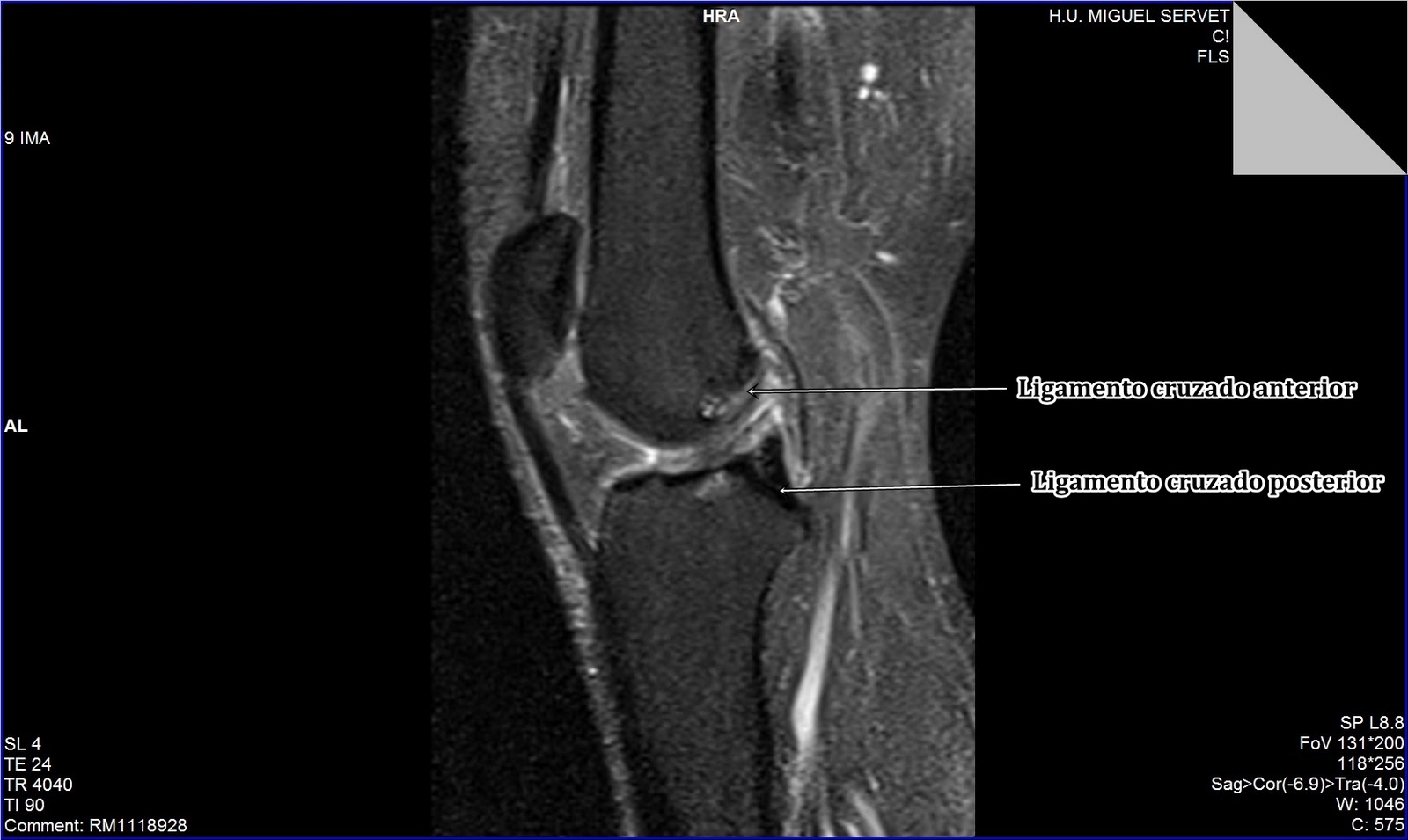 La gaceta del técnico de rayos: Protocolo de rodilla en Tomografía por ...