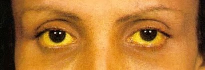 Ictericia; Ictericia Hemolítica