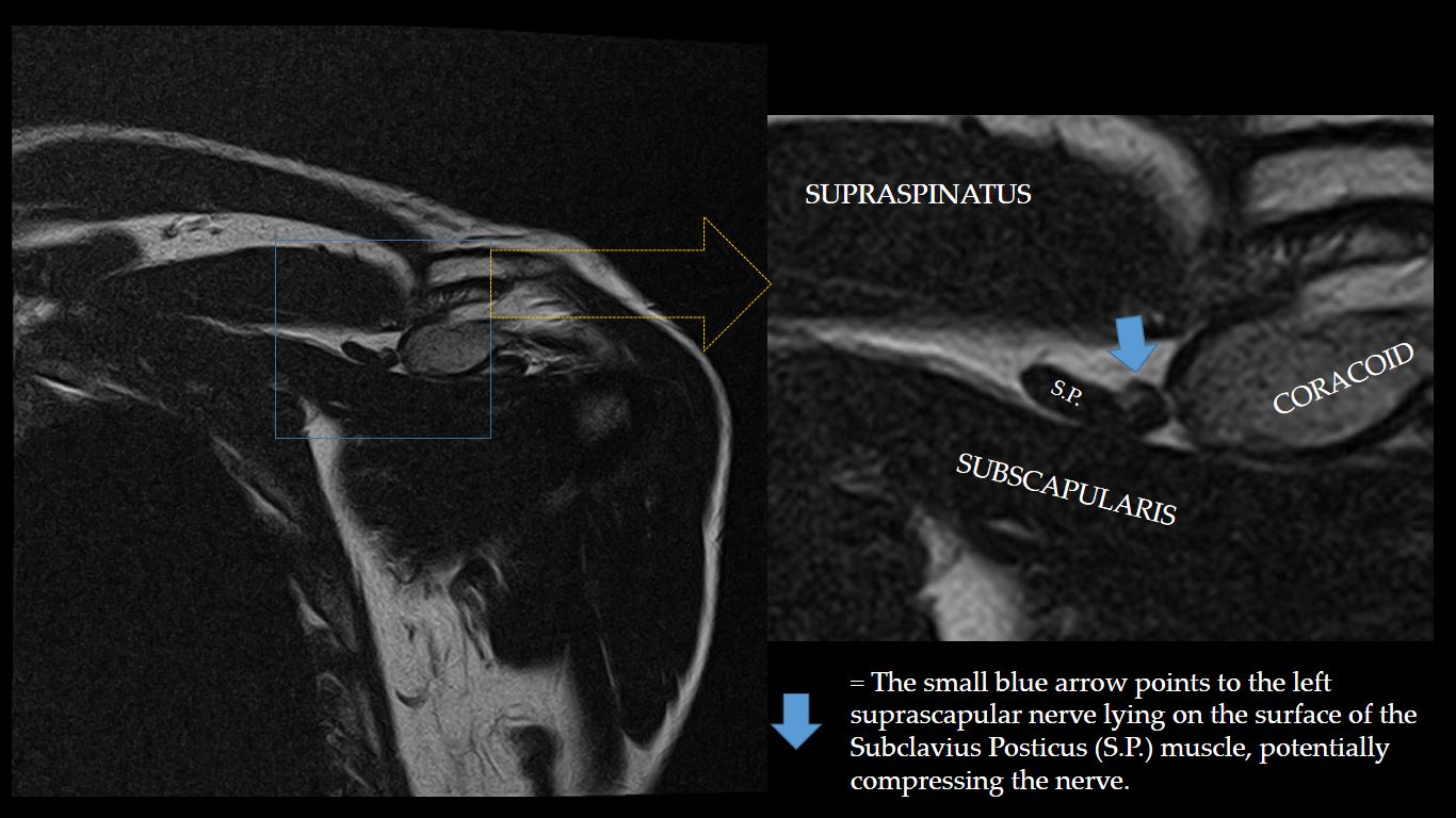 Ultimate Radiology : Subclavius Posticus ! - An accessory muscle of the ...