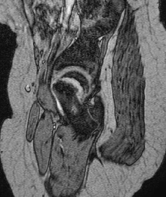 Slipped Upper Femoral Epiphysis-MRI - Sumer's Radiology Blog