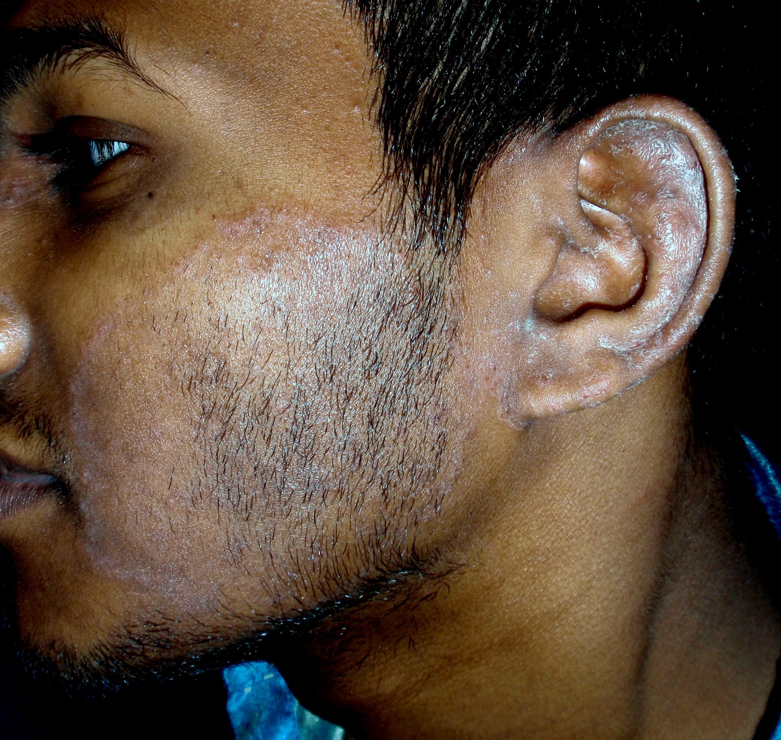 Residentes de familia en Lanzarote.: Tiña faciei.