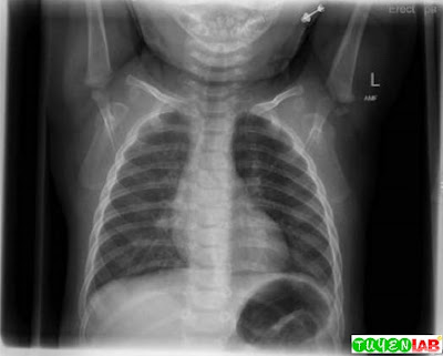 [Pediatric] Atlas of Bronchiolitis | Free Medical Atlas