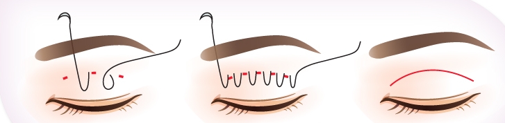 BK Plastic Surgery: [BK Plastic Surgery] Eyelid surgery: Partial ...