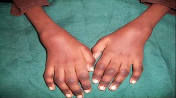Pediatrics Notes: Clinical Manifestations of Juvenile Rheumatoid Arthritis