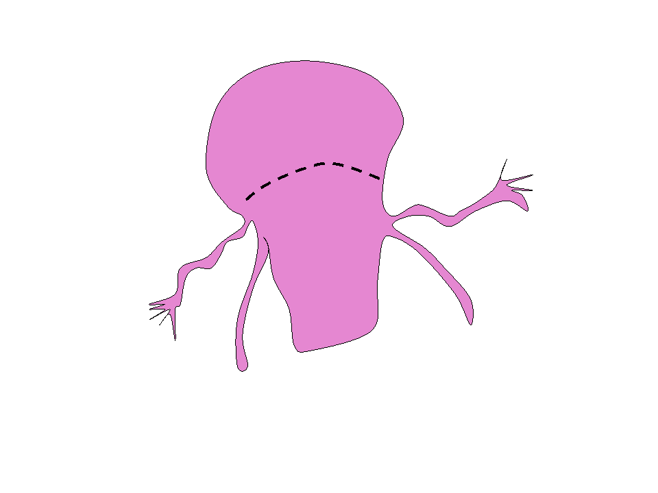 शशांक परुळेकर: Bonney's Hood Operation: Inverted T-shaped Incision