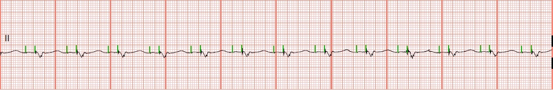 EKG Rhythm Strip Quiz 56: Paced Rhythms