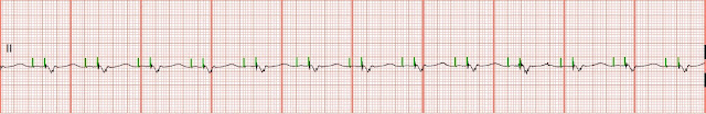 EKG Rhythm Strip Quiz 56: Paced Rhythms