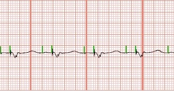 EKG Rhythm Strip Quiz 56: Paced Rhythms