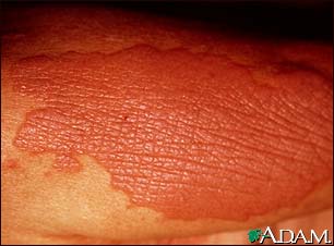 Skin And Facial Treatments: Eczema