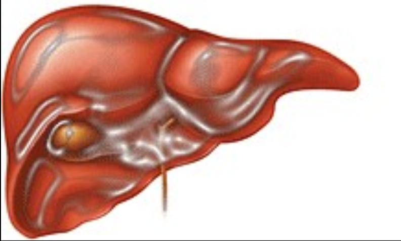 SRI AMAR SABAH SNAKE GRASS: FATTY LIVER