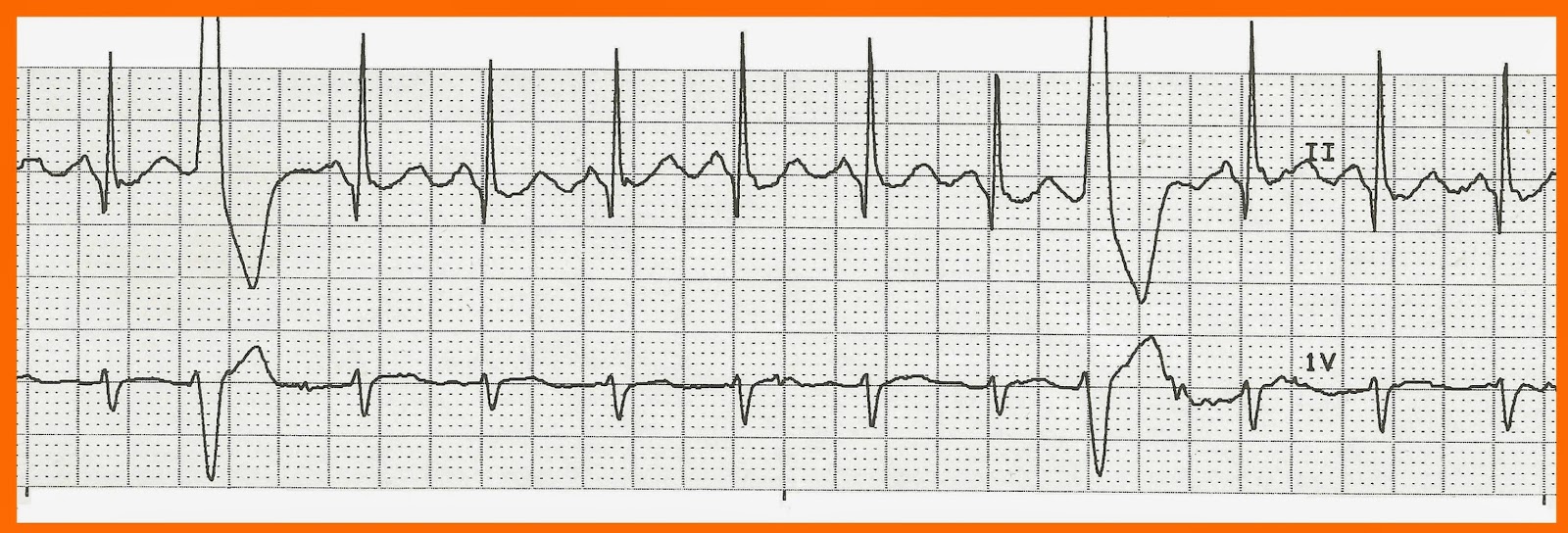 Practice EKG Strips 219