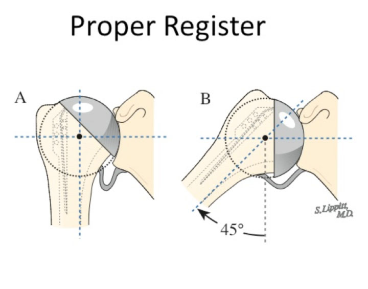 UW Shoulder and Elbow Academy: Shoulder joint replacement step by step ...