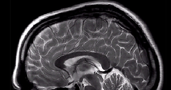 El Baúl Radiológico: ASPECTO DE LA CISTERNA MAGNA EN TOMOGRAFÍA ...