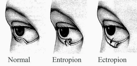 Cirugía Oculoplástica: Cirugía de Ectropión o Entropión