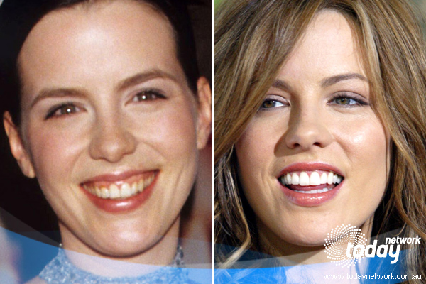 Kate Beckinsale Plastic Surgery Before And After: Kate Beckinsale ...