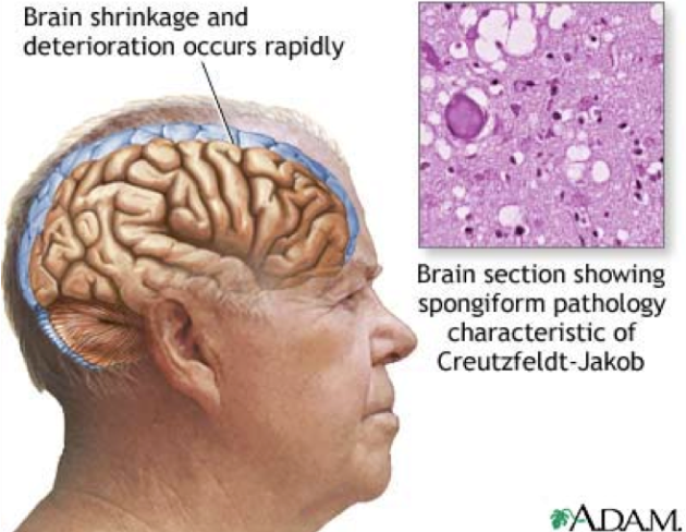 Blog de Carlos: QUÉ SON LOS PRIONES?/PRION DISEASES