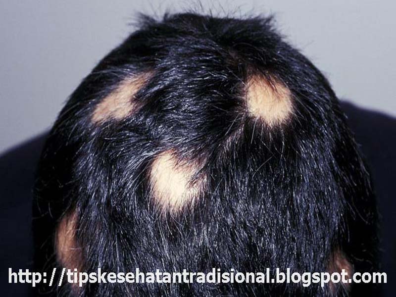 >>>Alopecia Difusa – Jenis Rambut Rontok