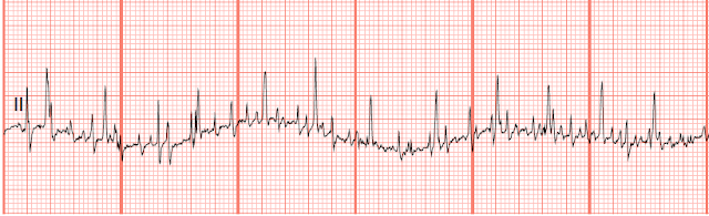 Basic EKG Rhythm Test 31