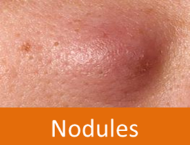 Types of Acne ~ Acne Slayer