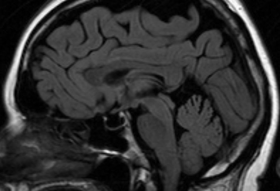 MedicoNotebook: Empty sella syndrome