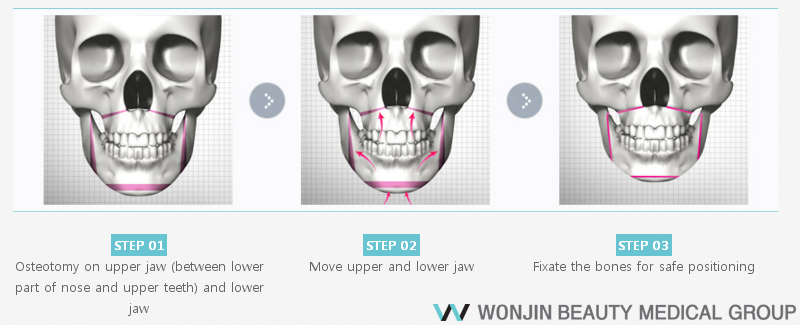 Korea Two Jaw Surgery Wonjin Beauty Medical Group - Jutting Jaw ...