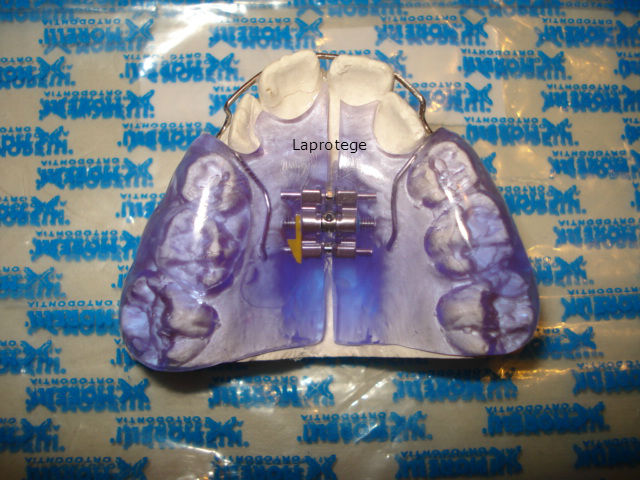 Laprotege: Aparelhos Ortodônticos