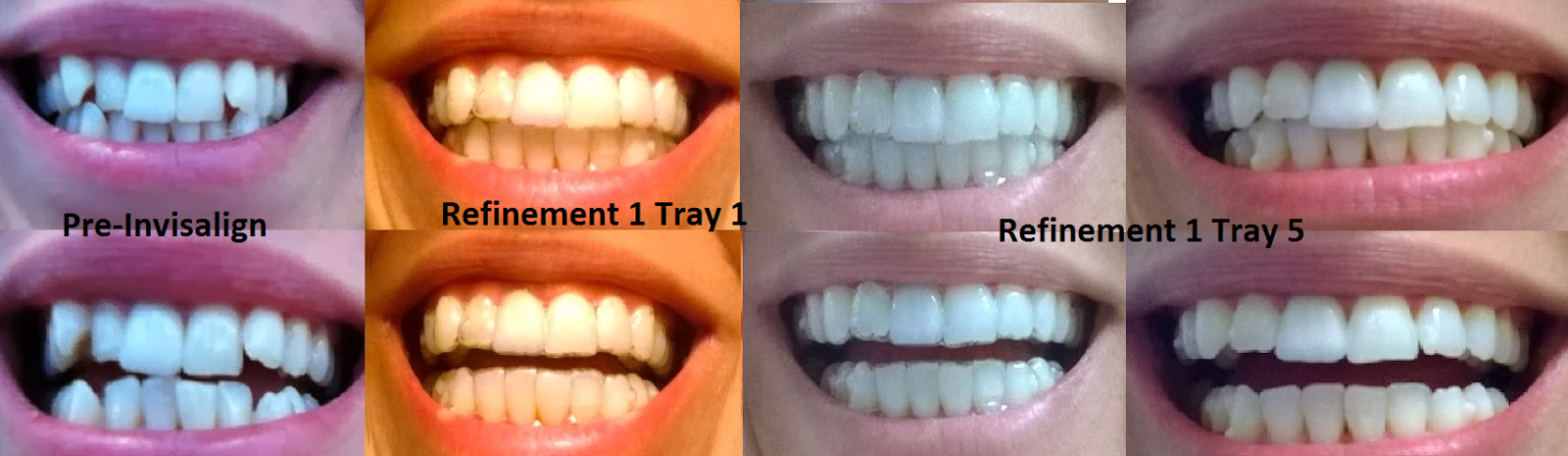 Michelle's Invisalign Journey: Refinement 1 Tray 5