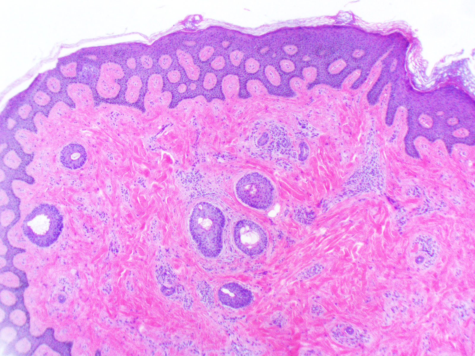 VIRTUAL GRAND ROUNDS IN DERMATOLOGY 2.0: Central Centrifugal ...